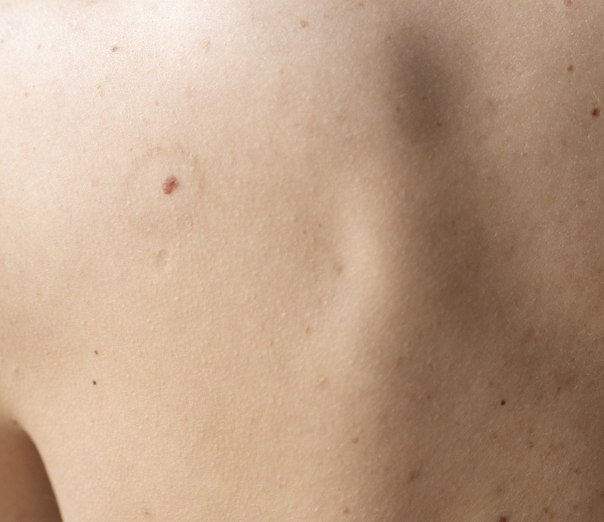 Clínica Andes Salud Concepción ¿Cómo saber si un lunar es saludable o ...